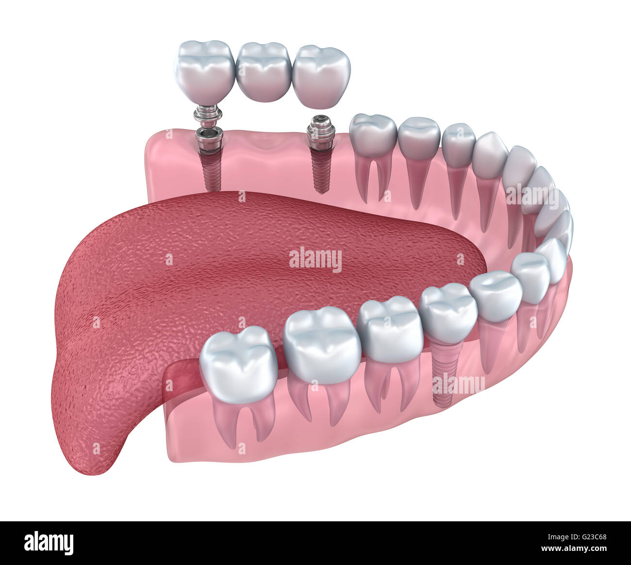 3d lower teeth and dental implant transparent render isolated on white ...