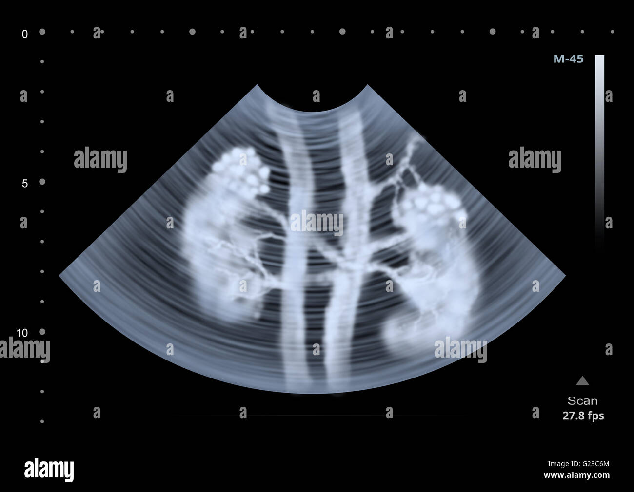 Ultrasound scan of human kidneys. Illustration Stock Photo - Alamy