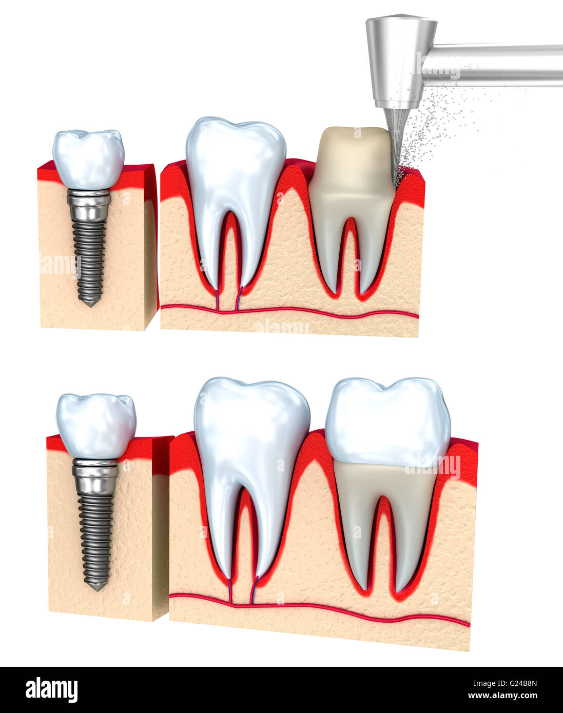 Dental crown installation process, isolated on white Stock Photo - Alamy