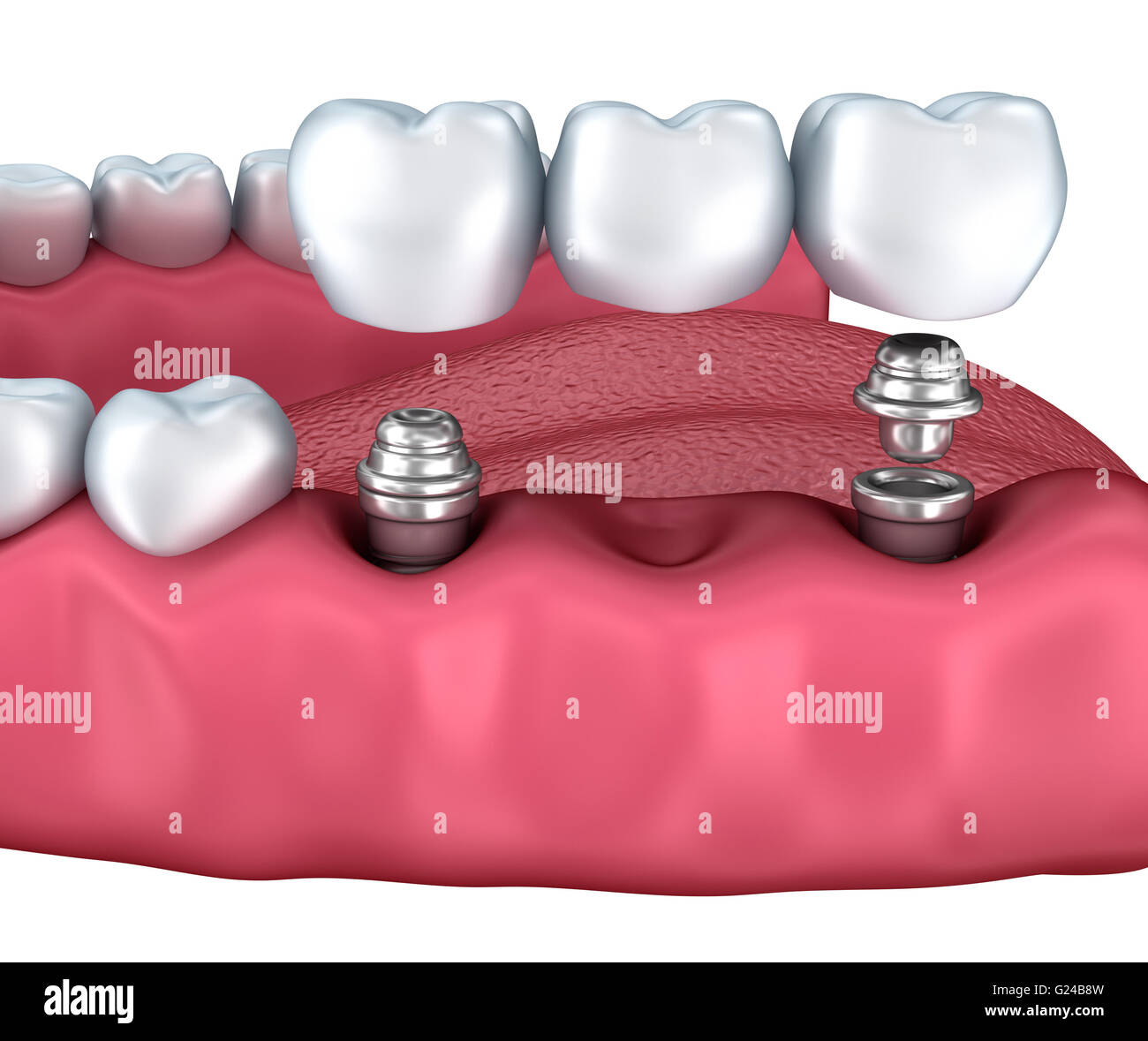 3d lower teeth and dental implant isolated on white Stock Photo - Alamy