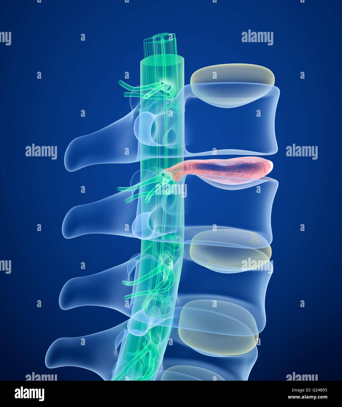 Spinal cord under pressure of bulging disc, X-Ray view. 3D illustration ...