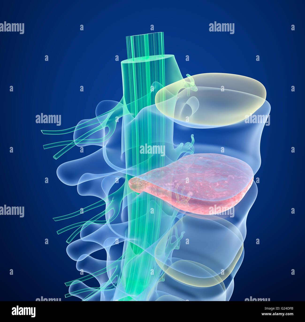 Spinal cord under pressure of bulging disc, X-Ray view. 3D illustration ...
