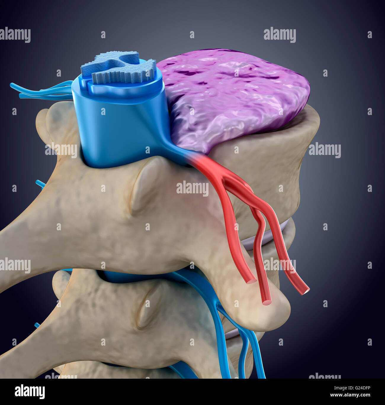 Spinal cord under pressure of bulging disc Stock Photo - Alamy