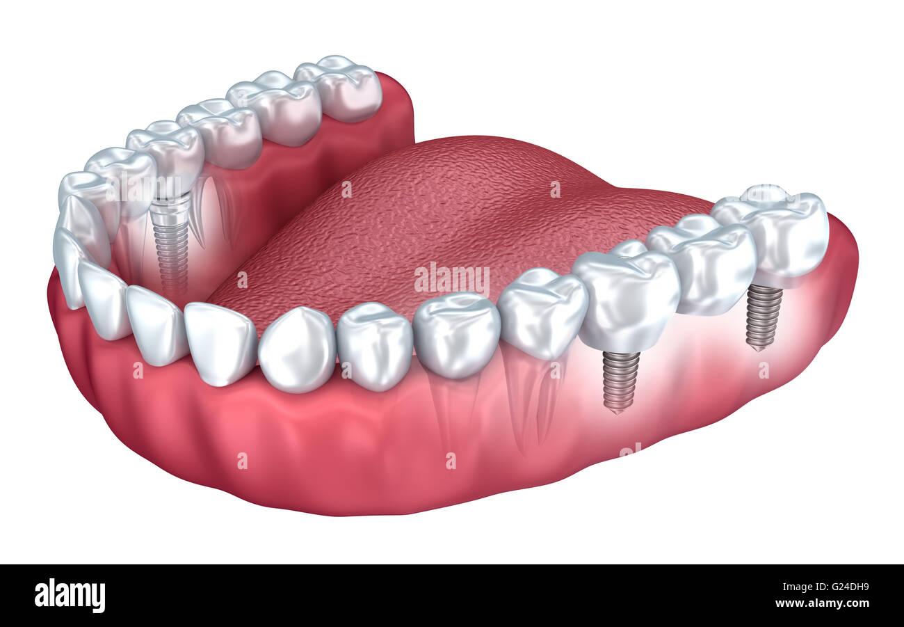 Artificial tooth Cut Out Stock Images & Pictures - Alamy