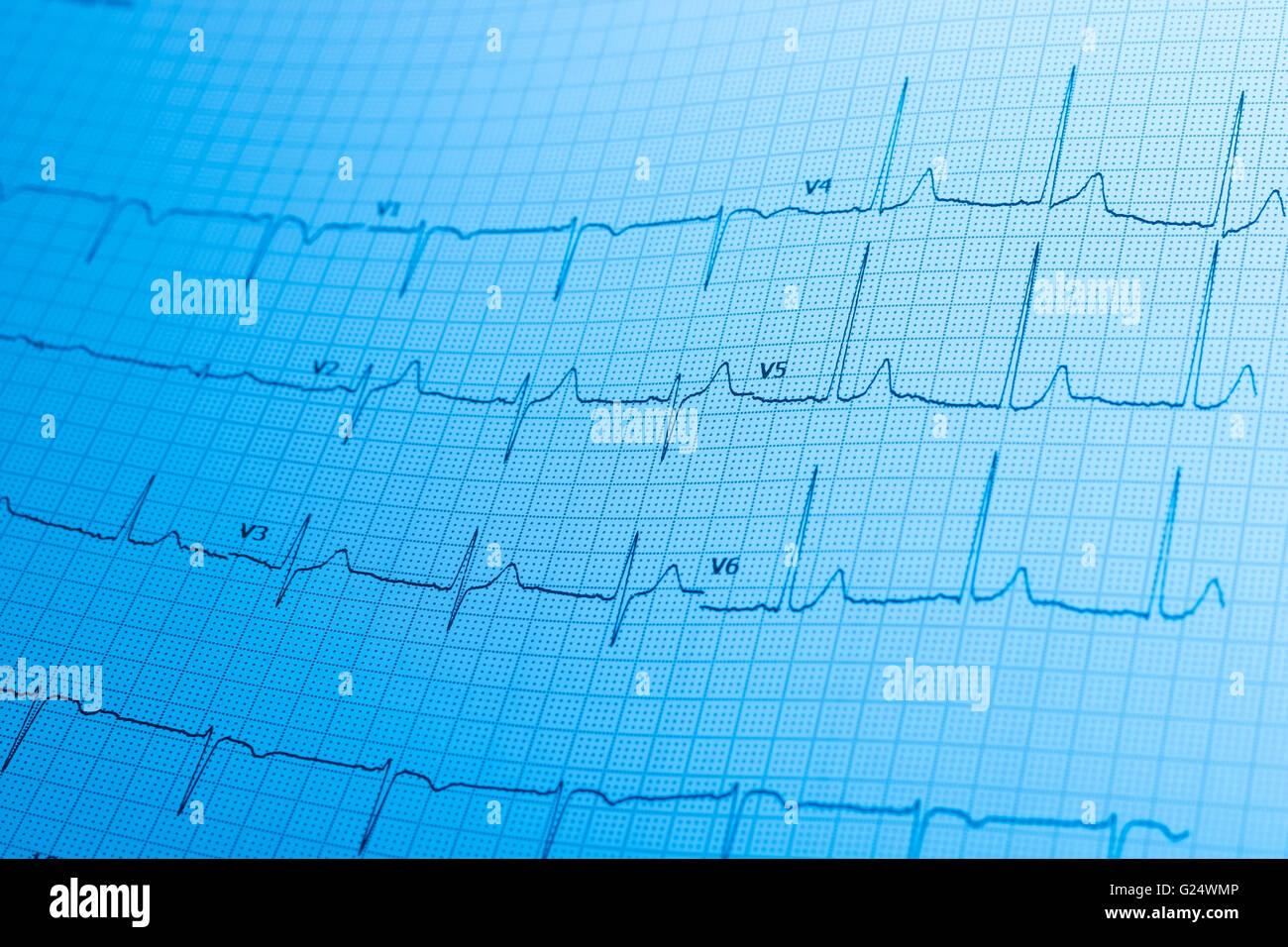 Electrocardiogram / ECG printed on graph paper Stock Photo - Alamy