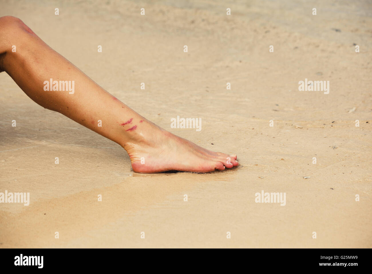 Woman Bruise Leg Stock Photos & Woman Bruise Leg Stock Images - Alamy