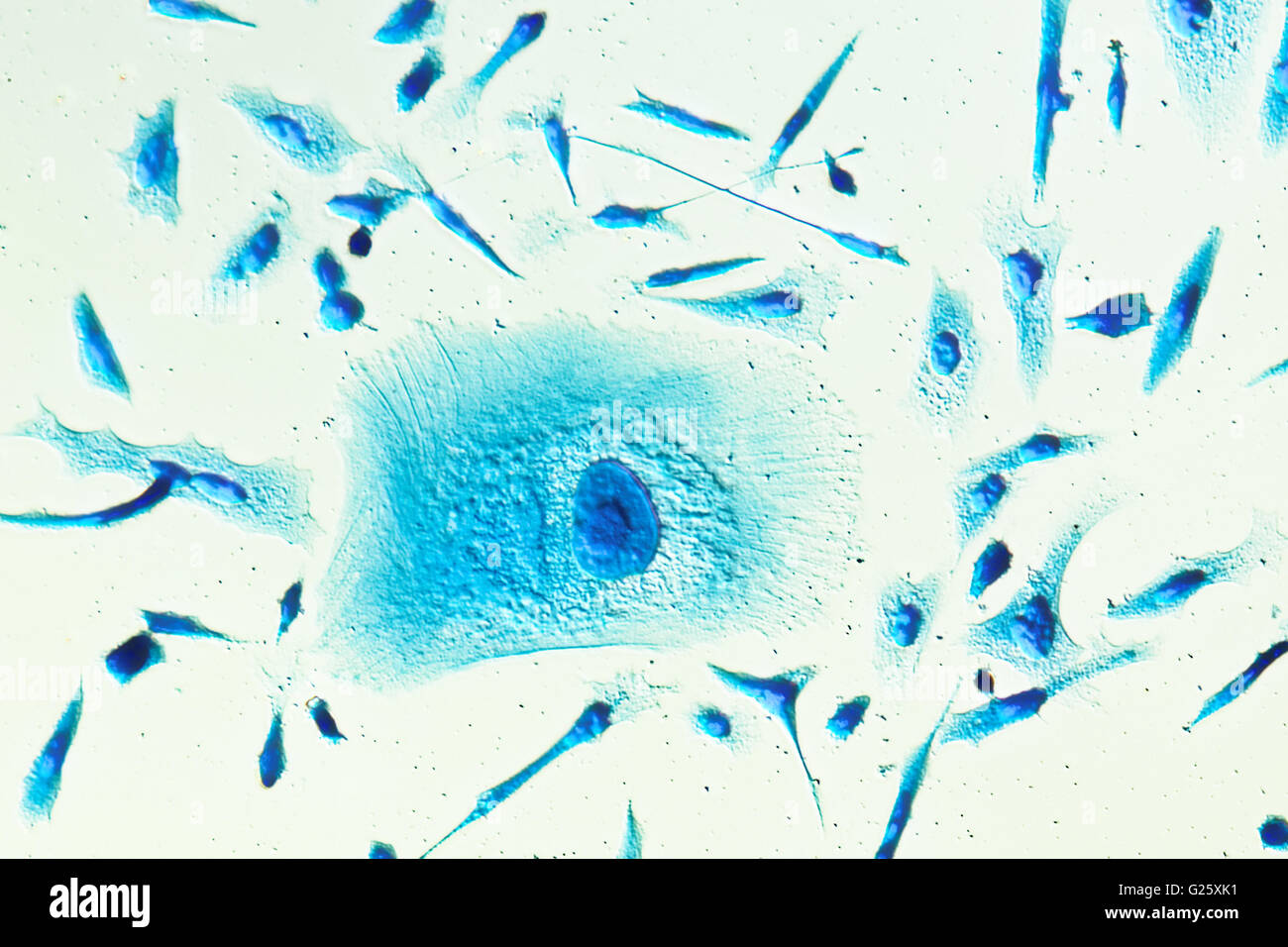 Prostate cancer cells High Resolution Stock Photography and Images - Alamy
