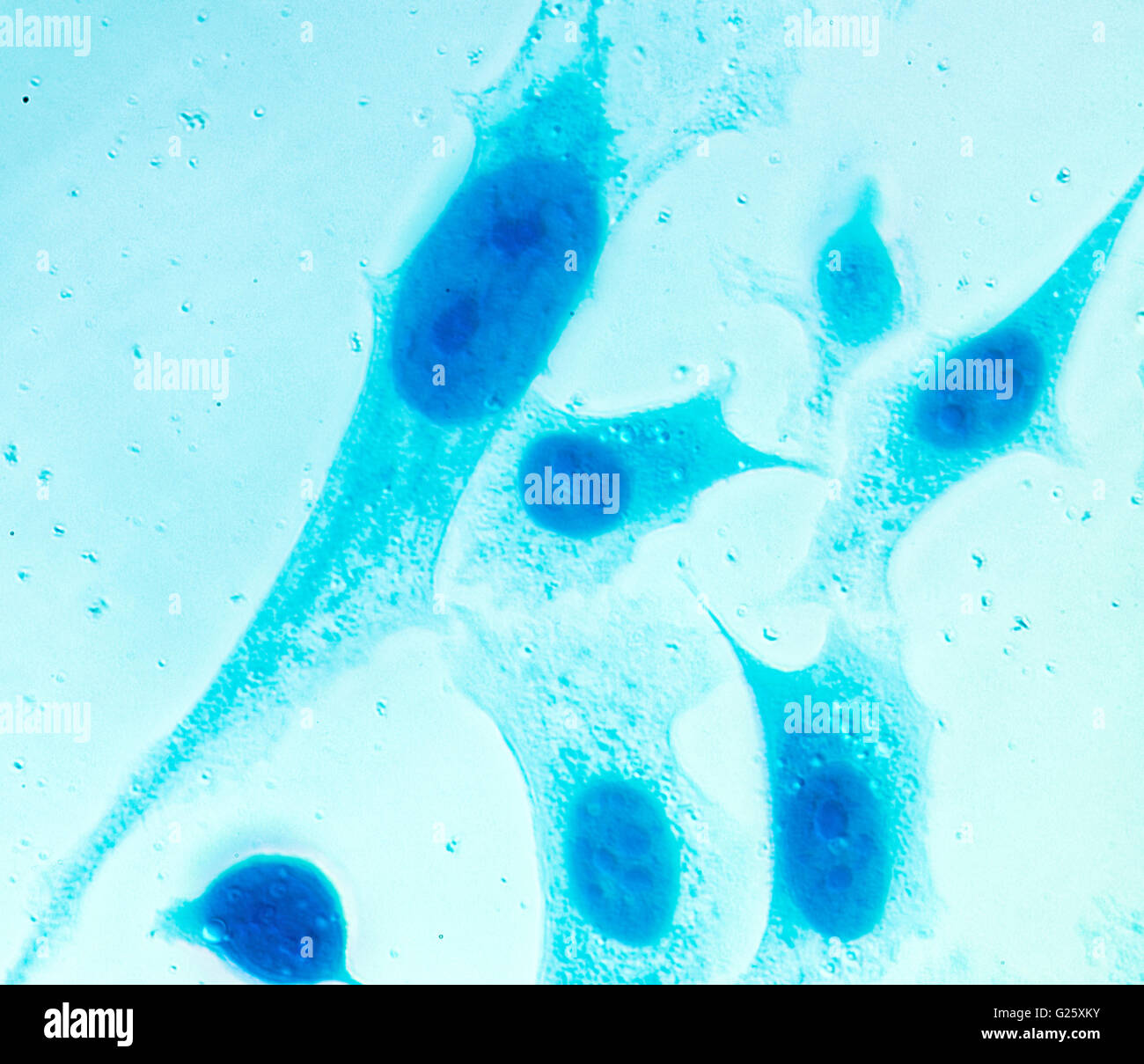 Prostate cancer cells High Resolution Stock Photography and Images - Alamy