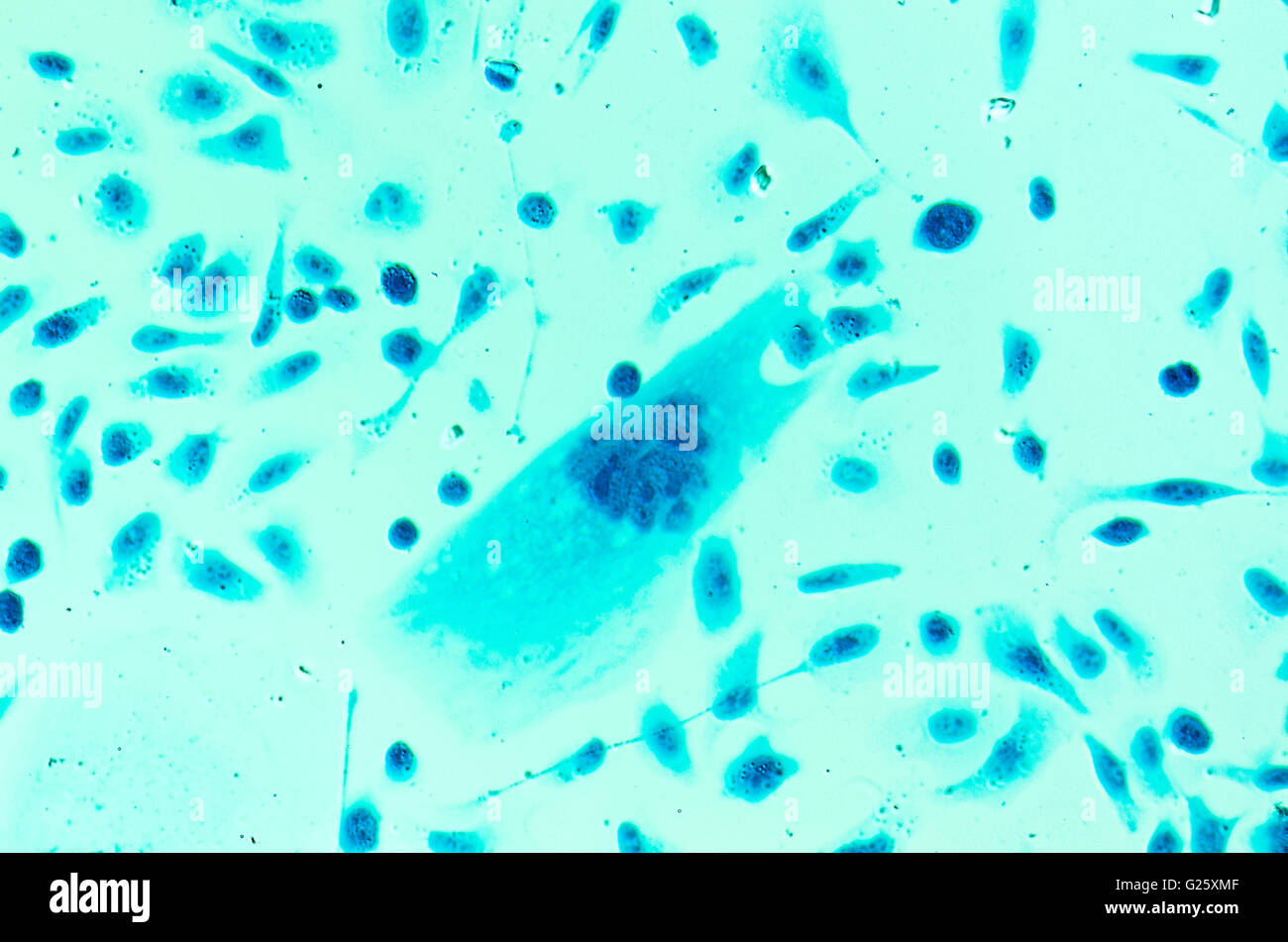 Prostate cancer cells High Resolution Stock Photography and Images - Alamy