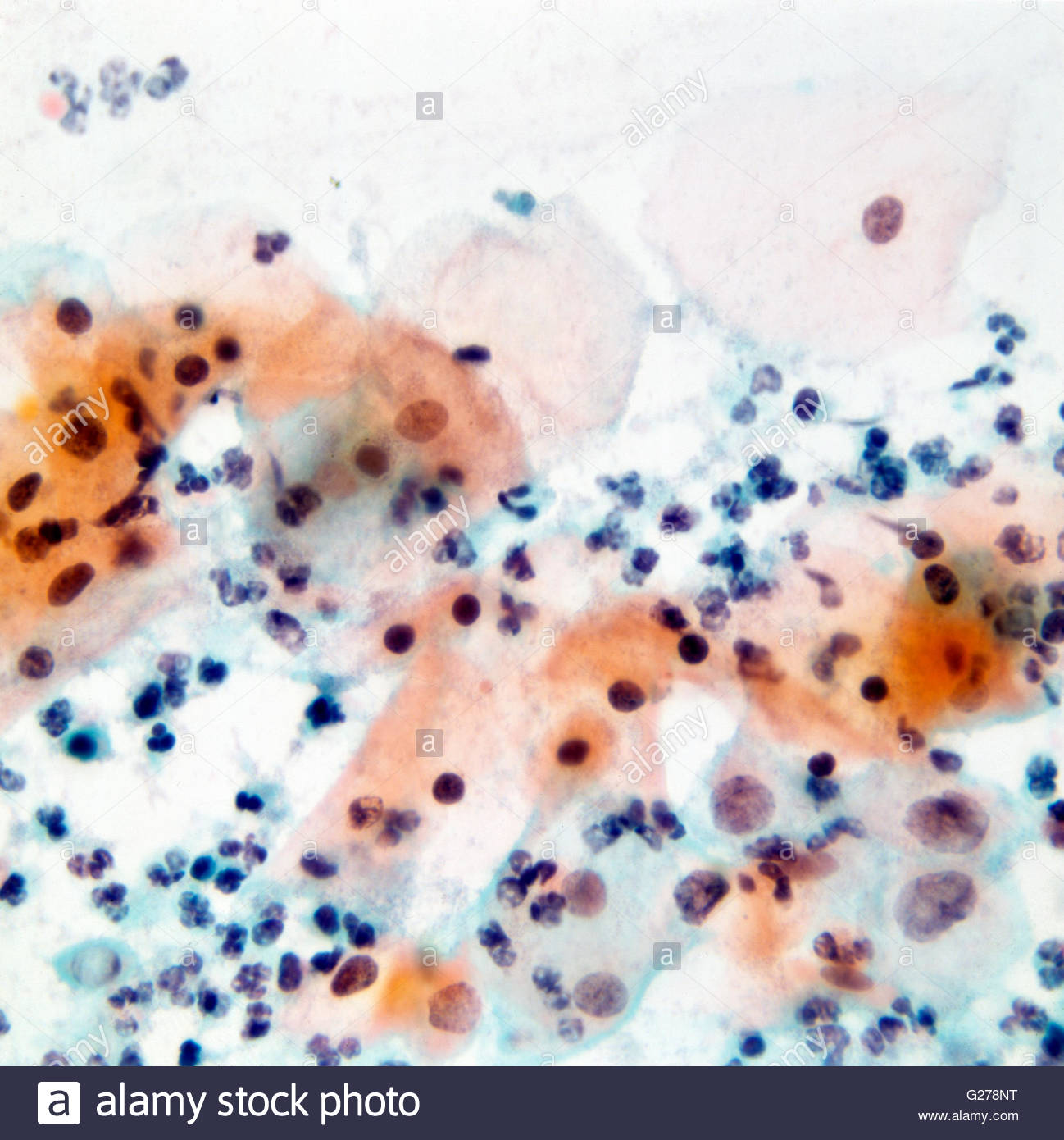 Squamous Cell Carcinoma Stock Photos & Squamous Cell Carcinoma Stock ...