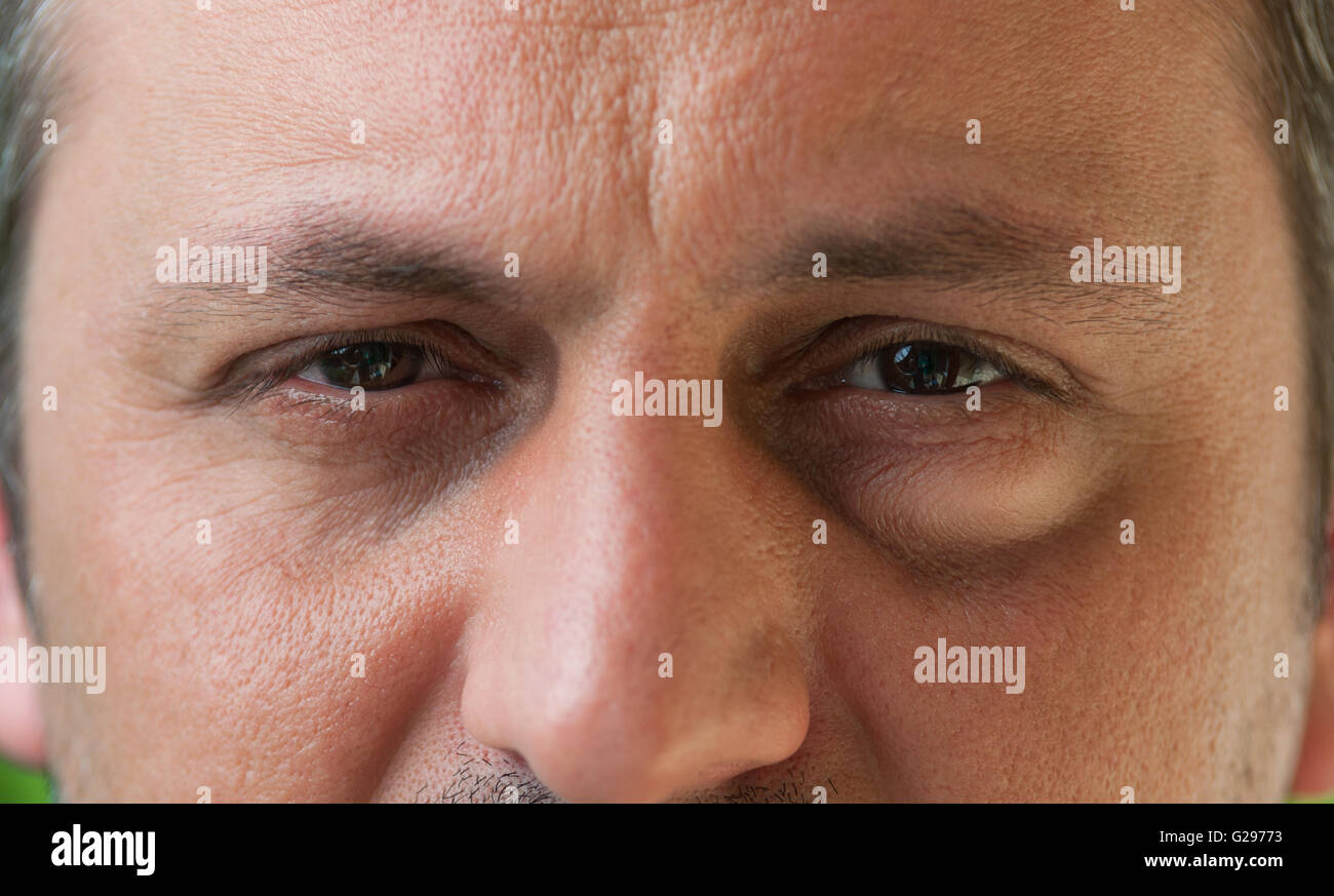 Man or male having one eye with conjunctivitis. Eyesore as medical ...