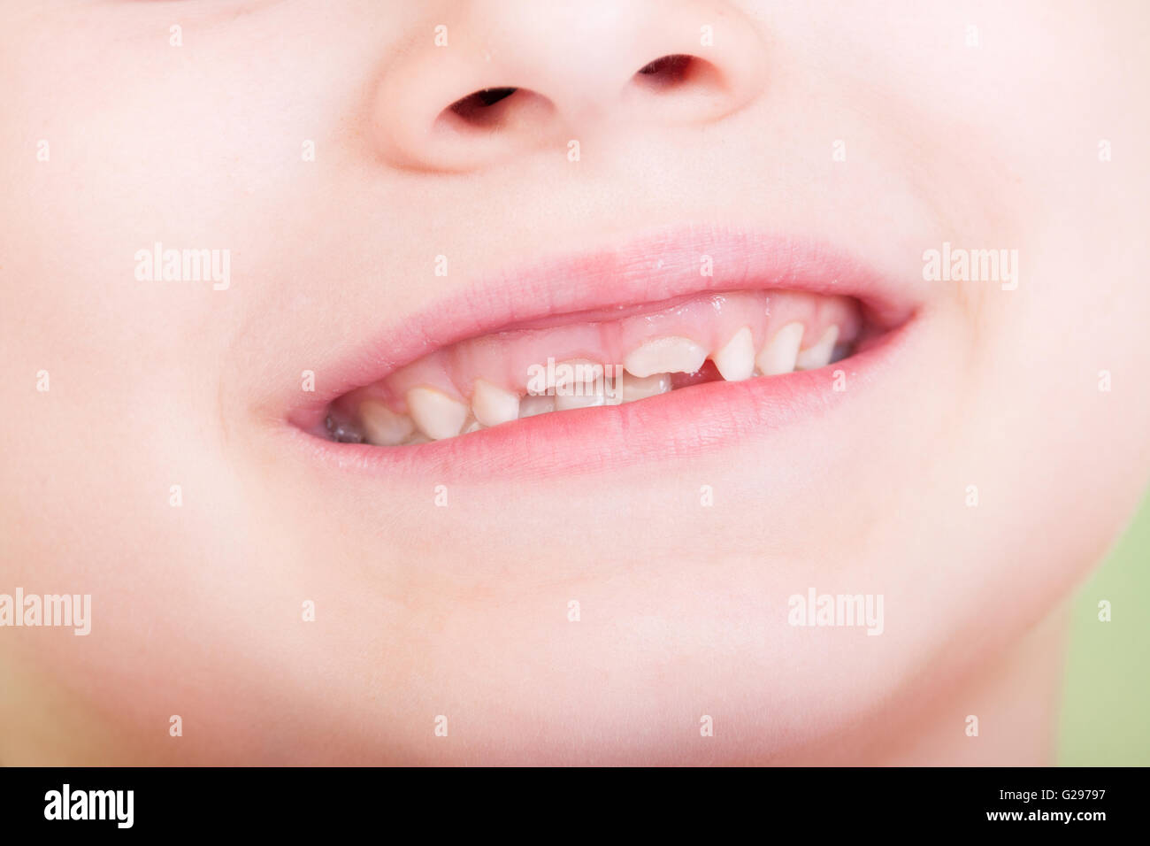 Closeup of child mouth with new front teeth growing Stock Photo - Alamy