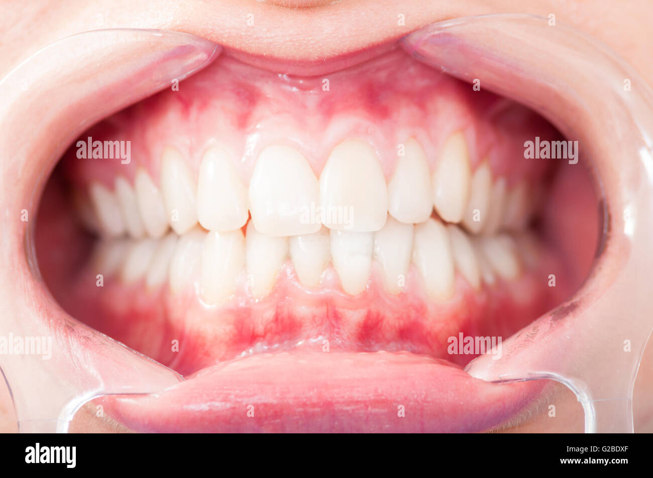 Close up of woman cavity protected by retractor showing perfect teeth ...