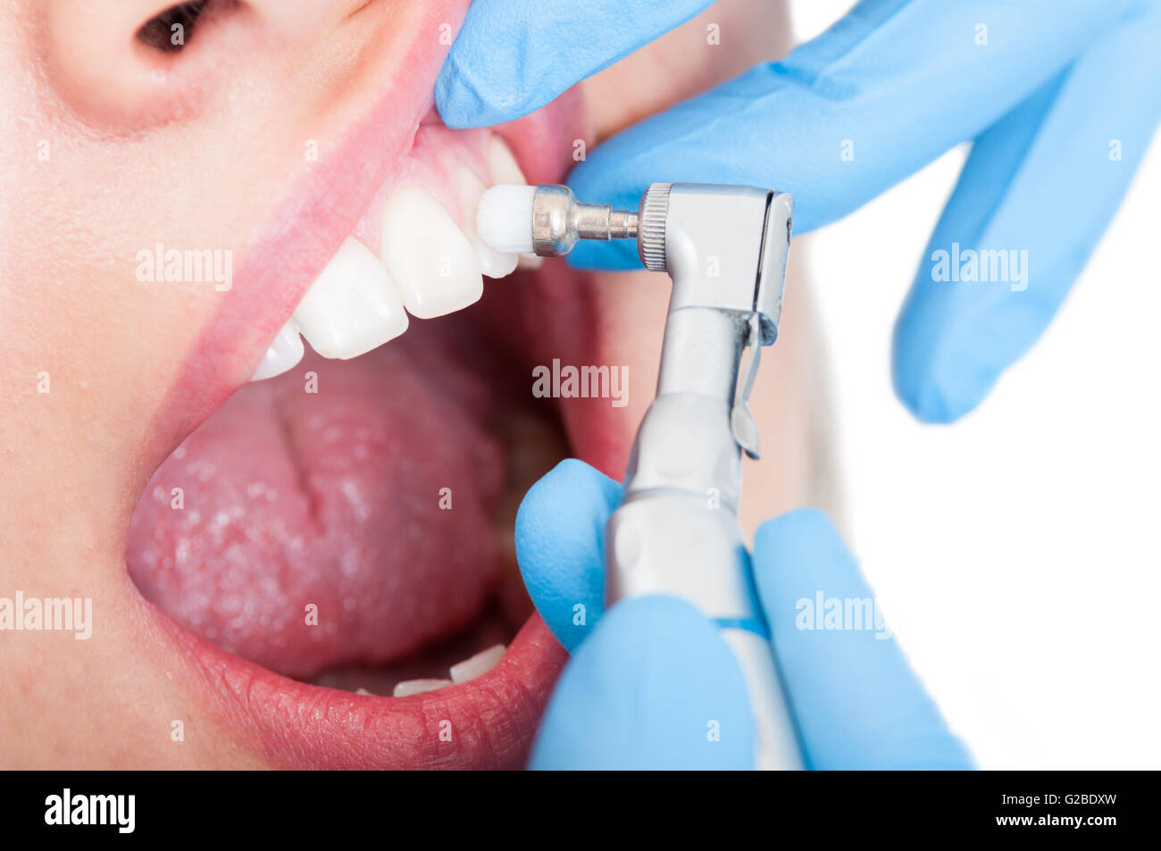 Closeup dentist doing dental hi-res stock photography and images - Alamy