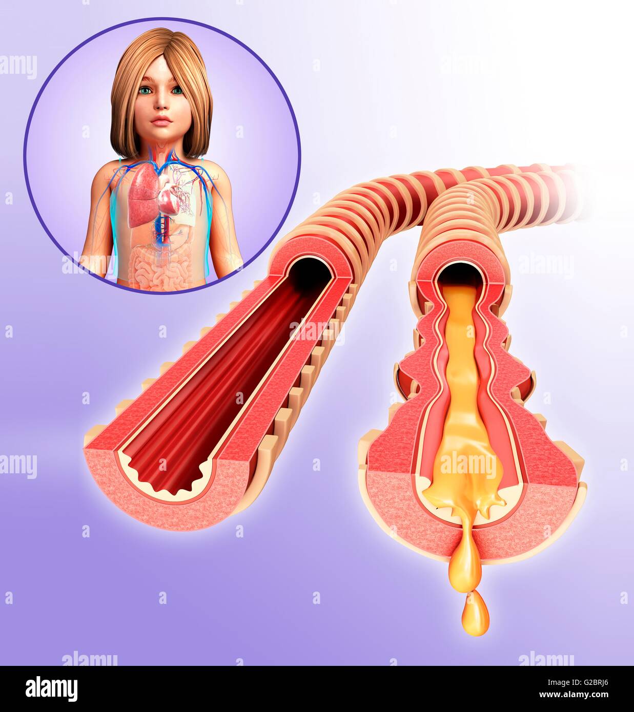 Infected bronchi of a child, illustration Stock Photo - Alamy