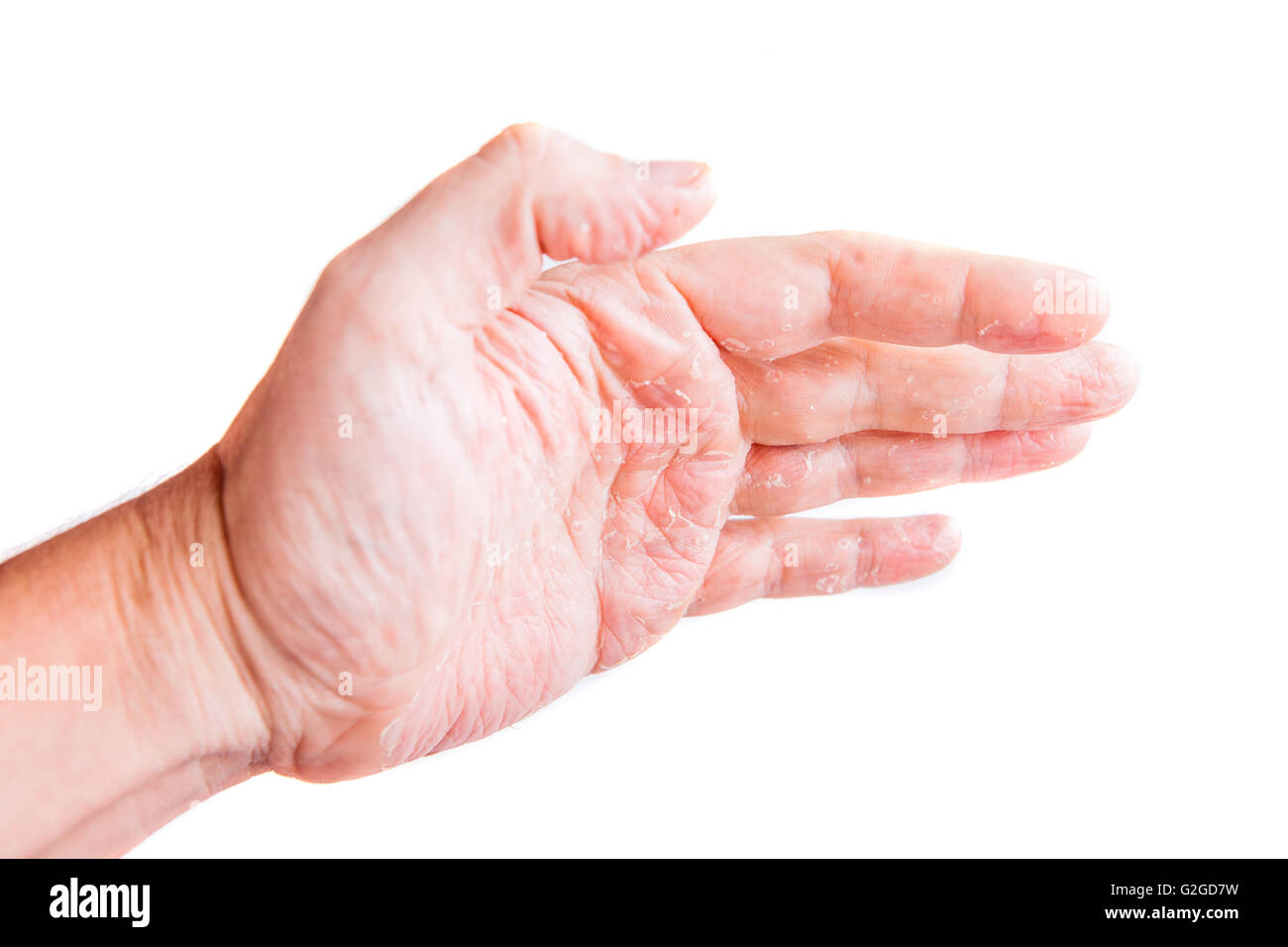 male palms with eczema isolated on white background Stock Photo - Alamy