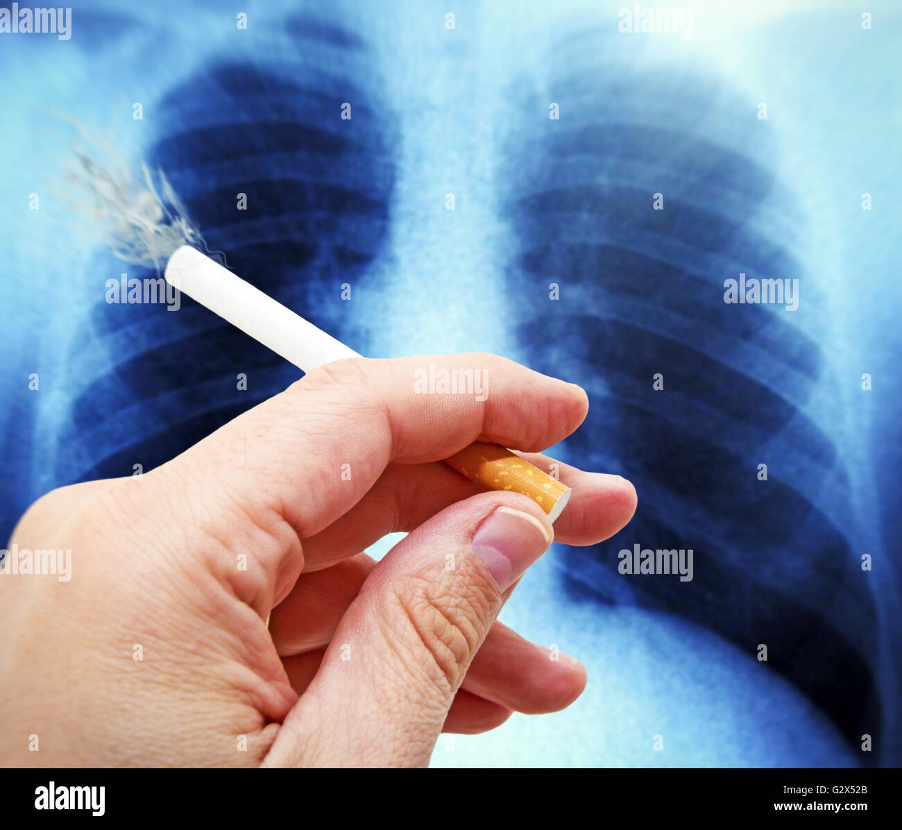 Smoking To Lung Cancer High Resolution Stock Photography and Images - Alamy