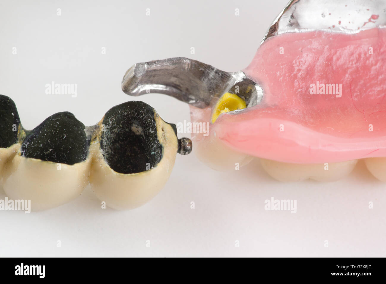 Clasp prosthesis with and attachments fixing ceramic crowns Stock Photo ...