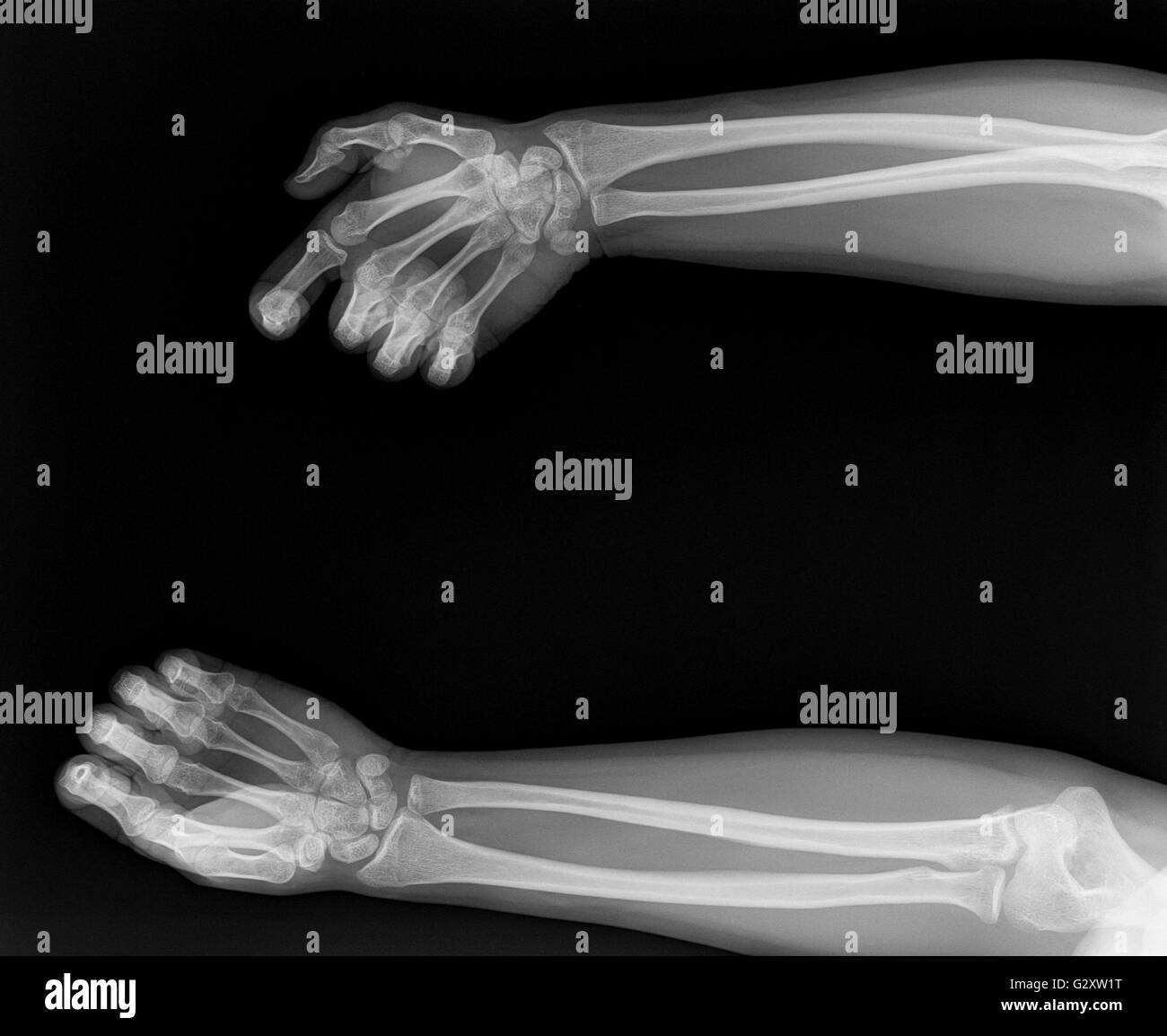 Hand xray hi-res stock photography and images - Alamy