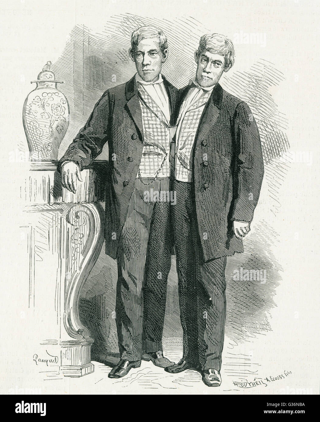 Chang And Eng Bunker Liver