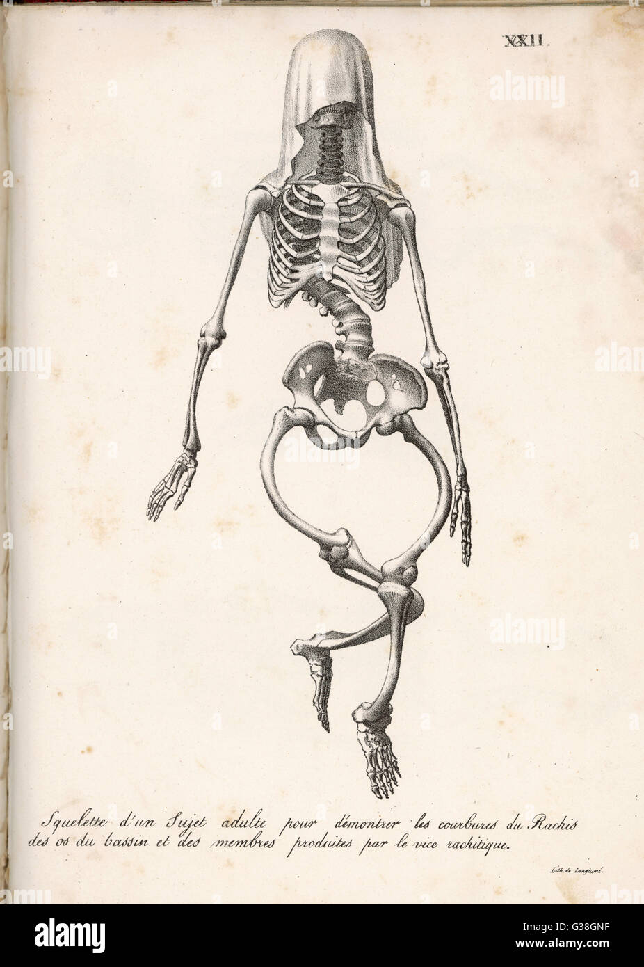 Rickets hi-res stock photography and images - Alamy