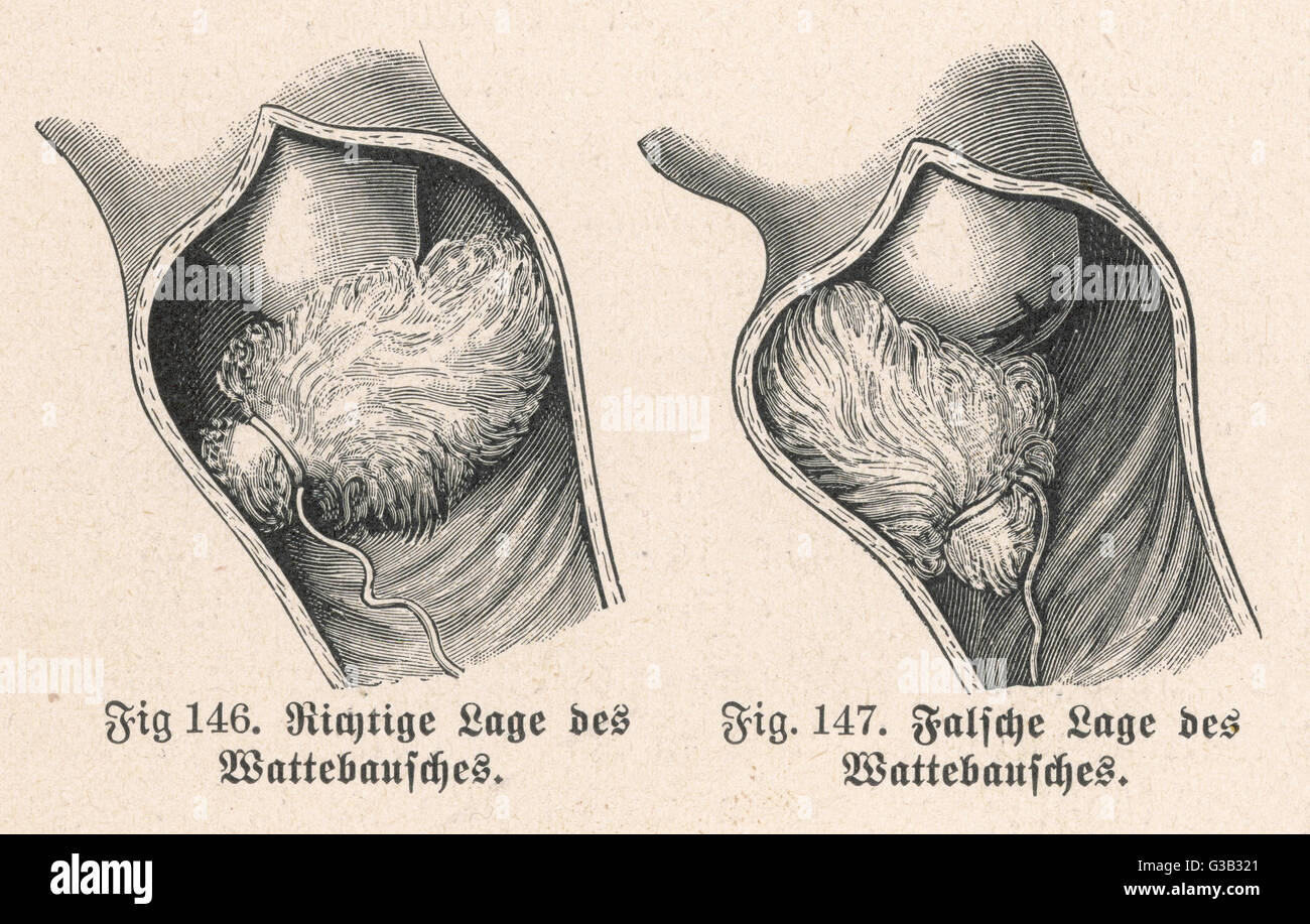 Contraception 1905 hi-res stock photography and images - Alamy