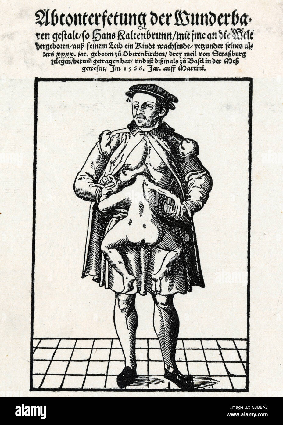 Conjoined twin human hi-res stock photography and images - Alamy