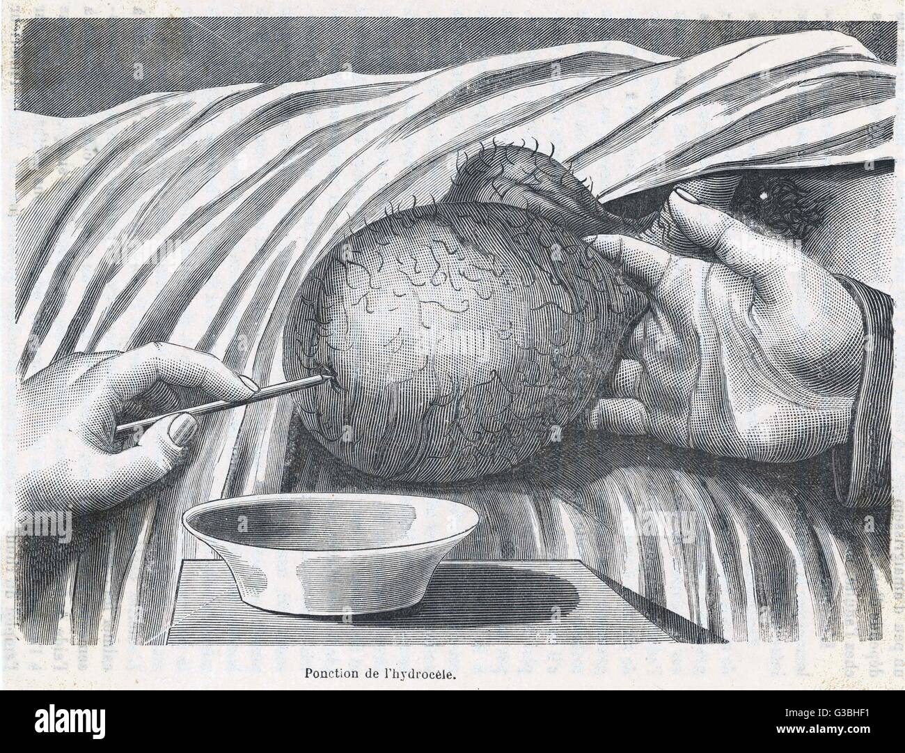 TESTICLE GROWTH DRAINED Stock Photo - Alamy
