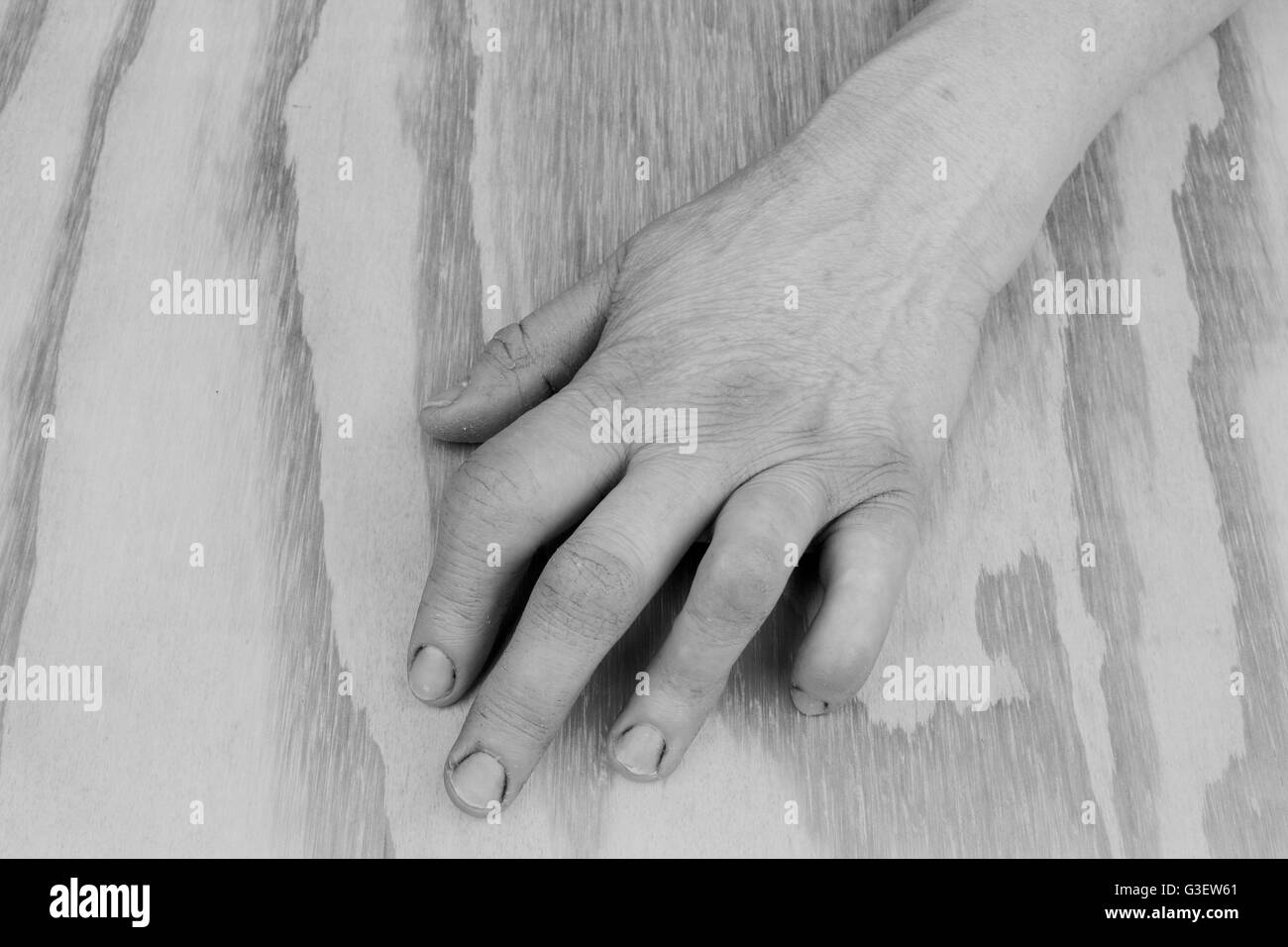 Woman's hand deformed from rheumatoid arthritis. Photo black and white ...