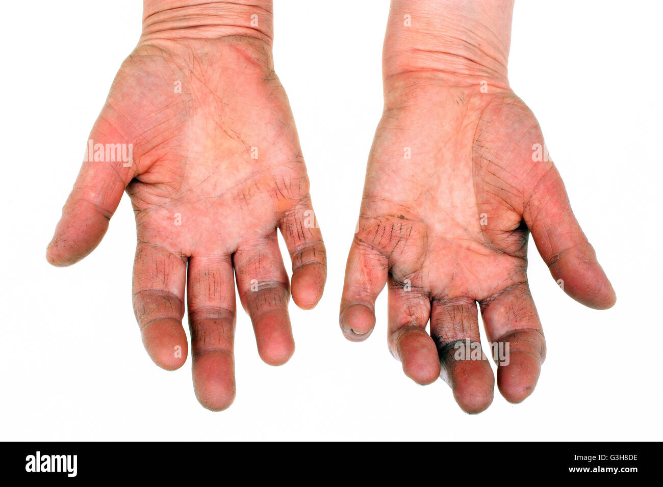 Rheumatoid arthritis hands. Isolated background Stock Photo - Alamy