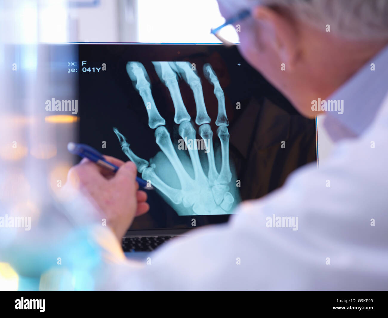 Radiographer looking at x-ray of hand fracture Stock Photo - Alamy