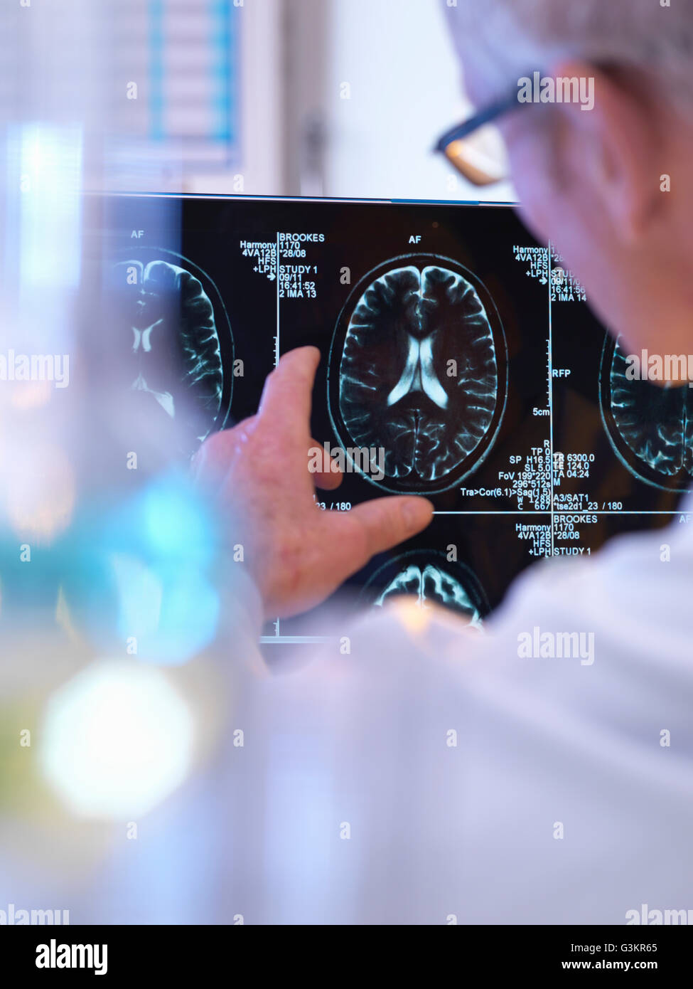 Brain ct scan hi-res stock photography and images - Alamy