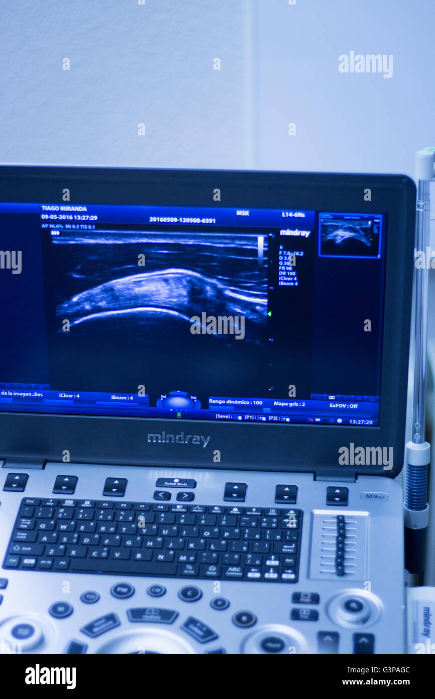 Ultrasound assisted ecography intratissue percutaneous electrolysis dry ...