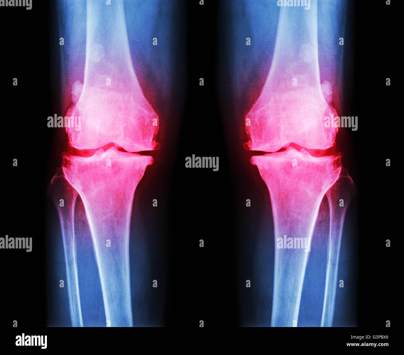 Osteoarthritis both knee . film x-ray AP ( anterior - posterior ) of ...