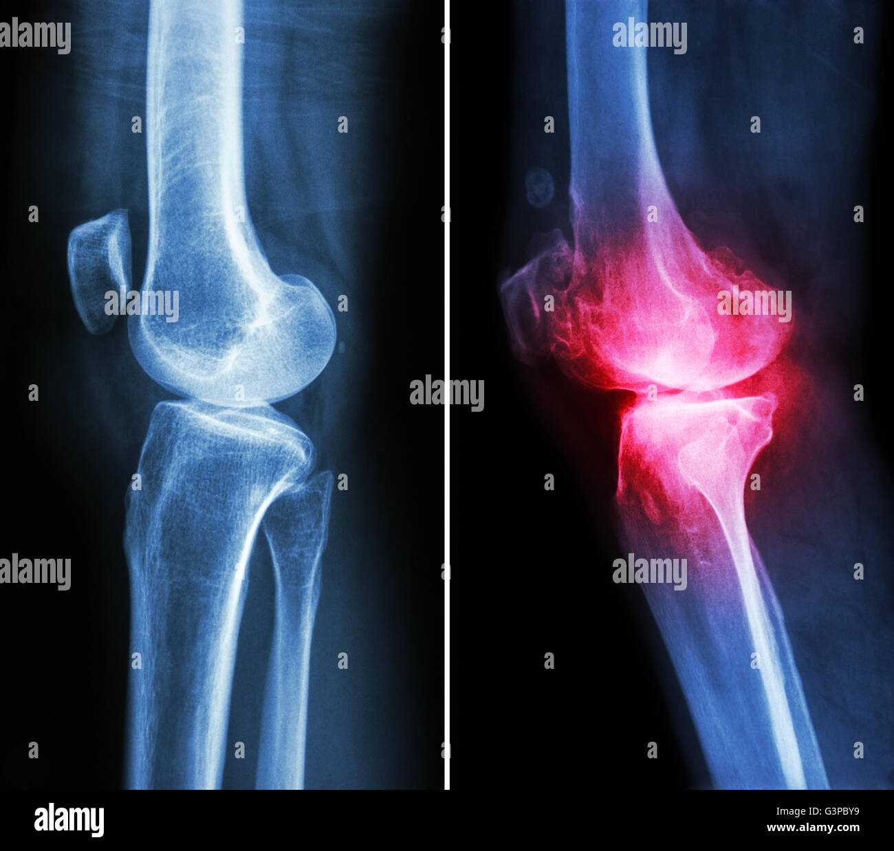 normal knee ( left image ) and osteoarthritis knee ( right image ...