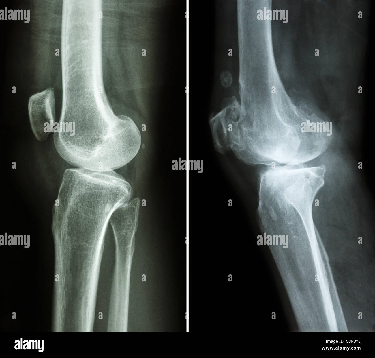 Normal Knee X Ray Stock Photos & Normal Knee X Ray Stock Images - Alamy Normal Knee X Ray Stock Photos & Normal Knee X Ray Stock Images - Alamy