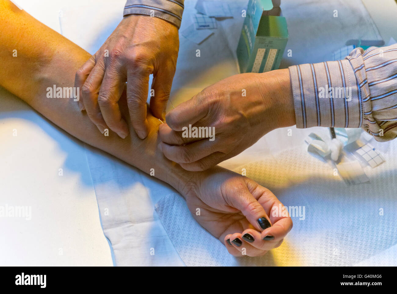 Woman getting acupuncture treatment on arm, Traditional Chinese ...