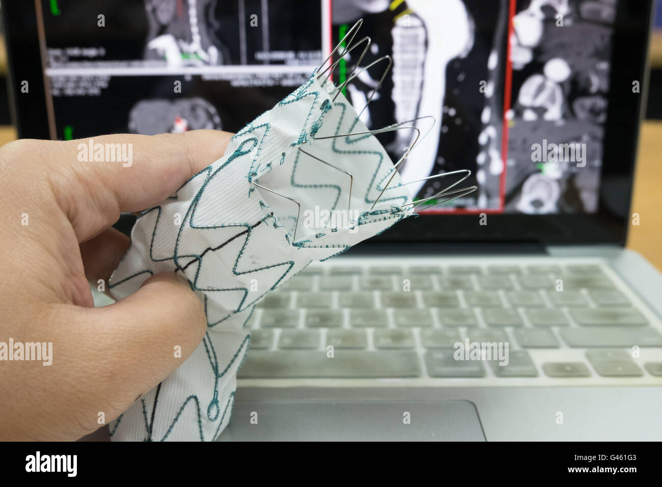 endovascular stent graft Stock Photo - Alamy