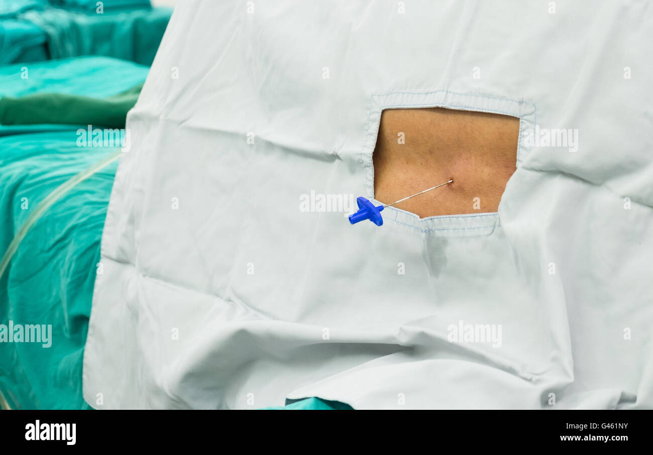 spinal nerve block Stock Photo - Alamy