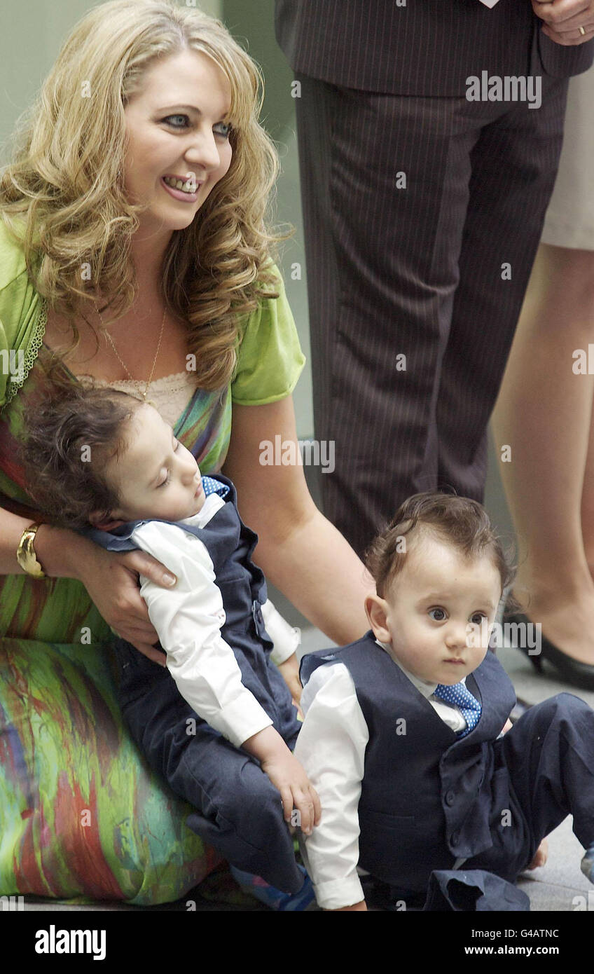 Conjoined twins hi-res stock photography and images - Alamy