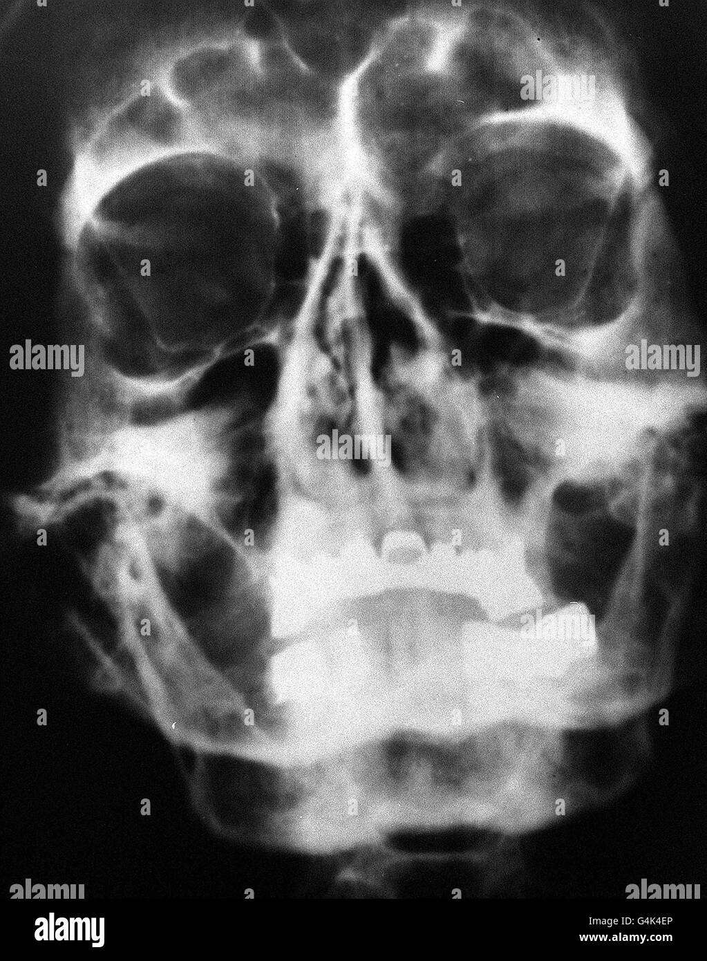 ADOLF HITLER SKULL Stock Photo - Alamy