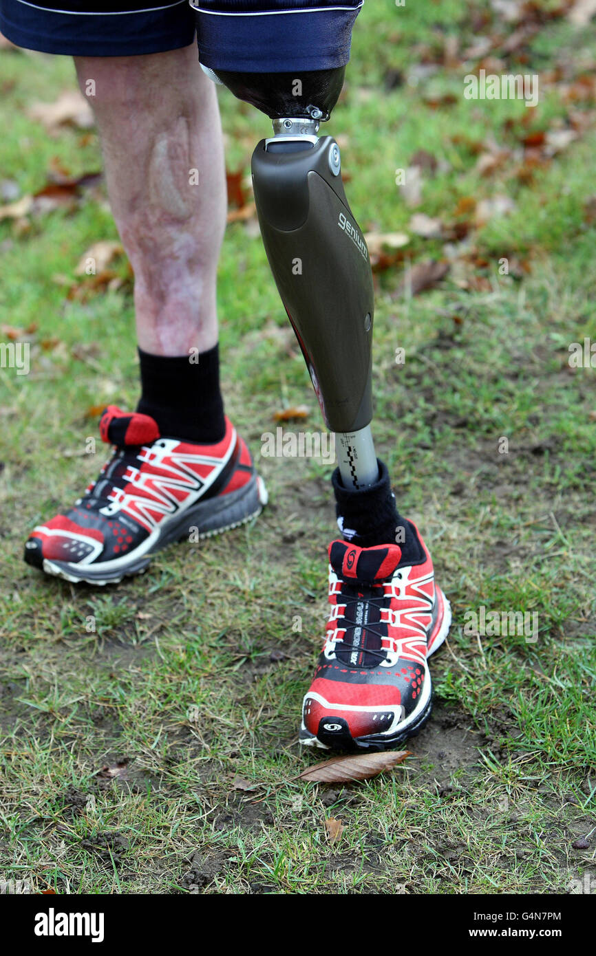 Became first uk patient fitted new bionic leg prosthetic system hi-res ...