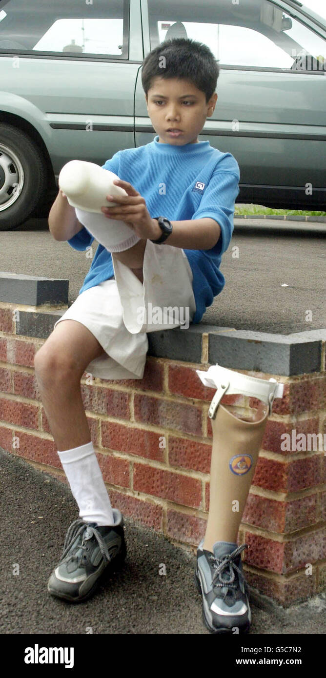 Parth Joshi, 11, whose leg was crushed in the Indian earthquake earlier ...