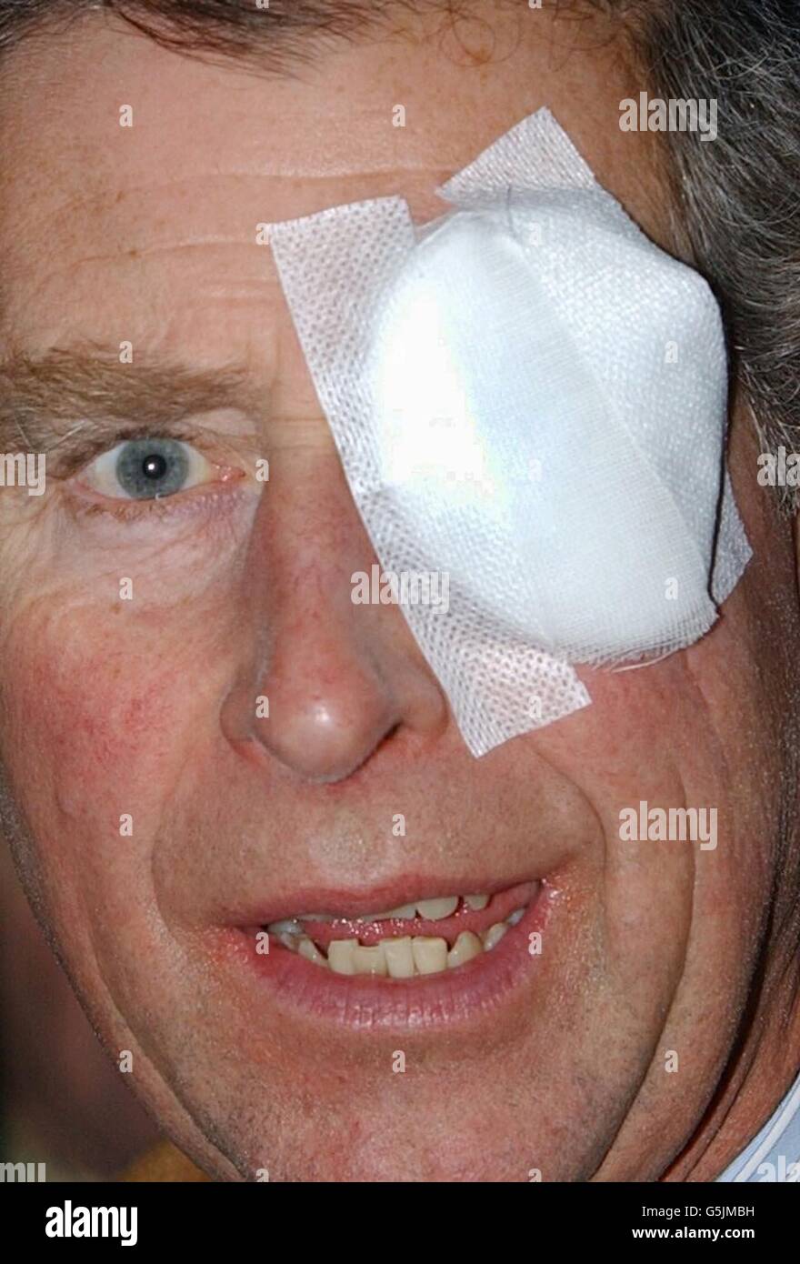 The Prince of Wales wears a patch over his injured eye as he arrives to ...