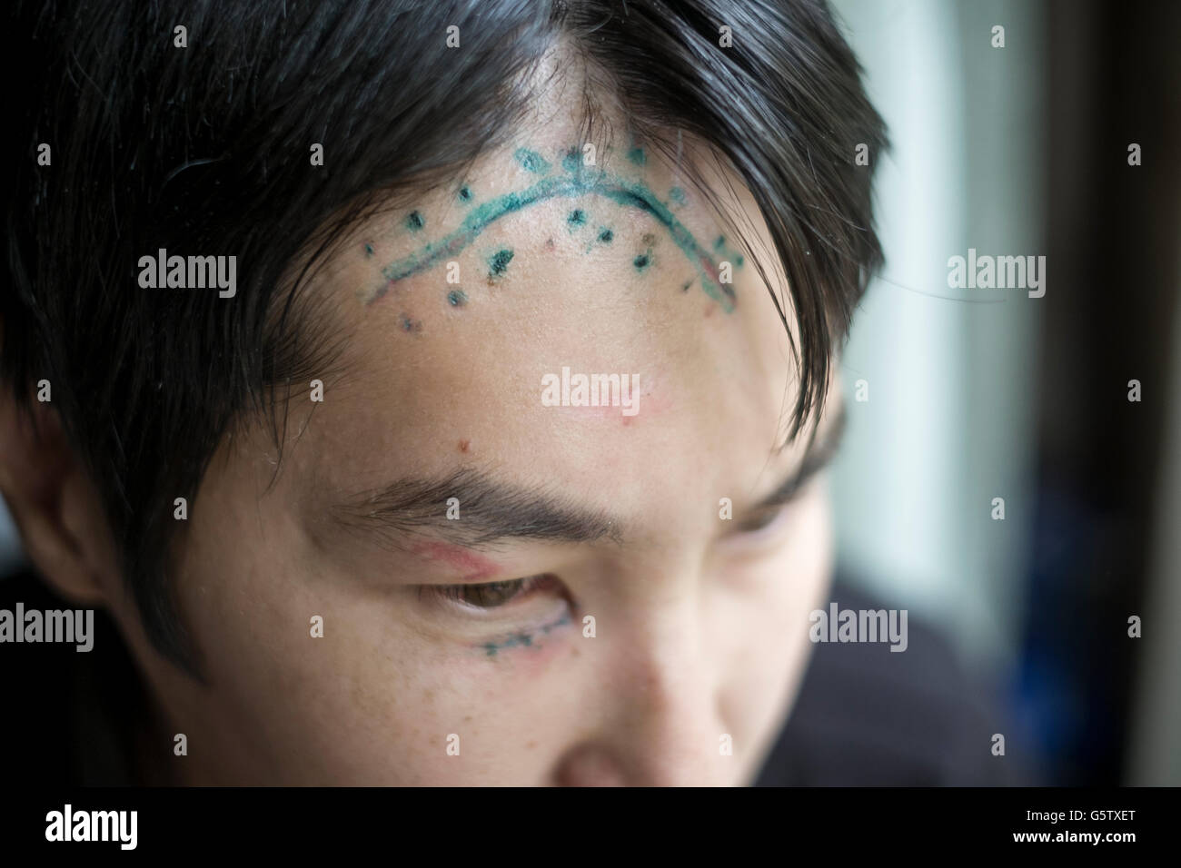 Forehead scar hi-res stock photography and images - Alamy