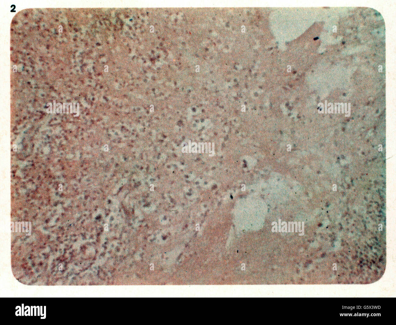 Granulation tissue hi-res stock photography and images - Alamy