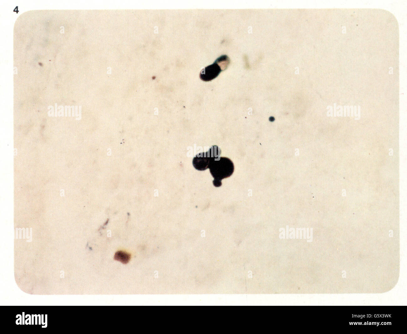 medicine, diseases, Blastomycosis, unipolar shoot cells, tumor wipe ...