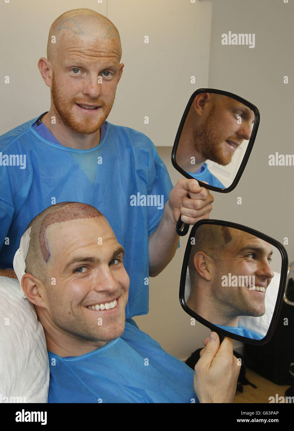 Brothers Barry Cowan (top) and Brian Cowan, after undergoing a FUE ...
