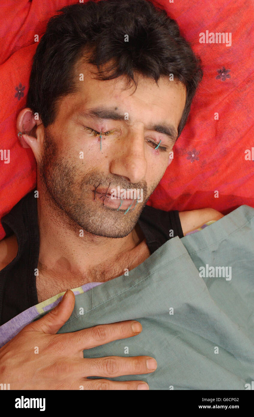 Iranian refugee Abas Amini, 33, who has stitched his lips, eyes and ...