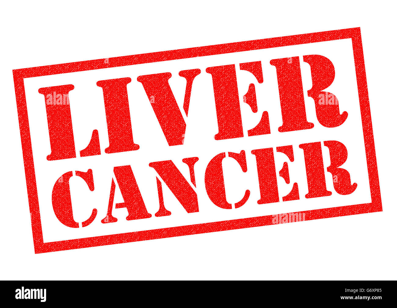 Liver cancer hi-res stock photography and images - Alamy